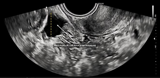Ultrasound Assessment of Pelvic Anatomy | Article | GLOWM
